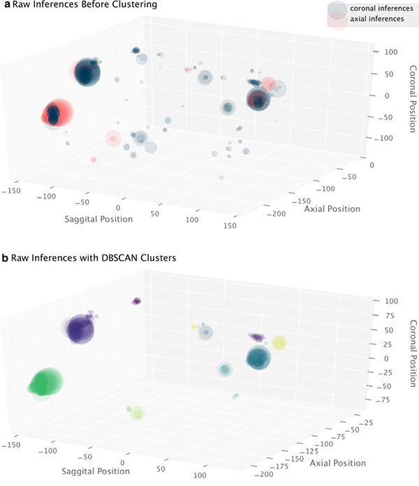 Ai And Lung Cancer Screening Using Ai To Improve Nodule Detection Intelligent Imaging